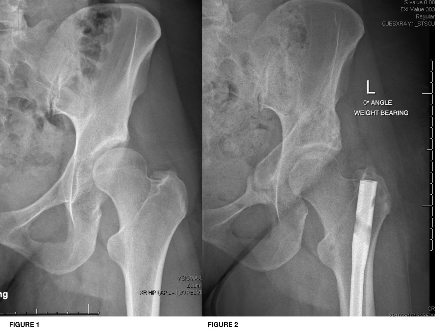 Derotational Femoral Osteotomy (DFO) - CU Sports Med Hip Clinic