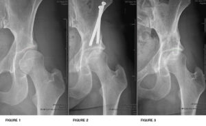 Periacetabular Osteotomy (PAO) - CU Sports Med Hip Clinic