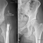 Procedures - CU Sports Med Hip Clinic