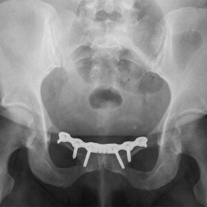Procedures - CU Sports Med Hip Clinic