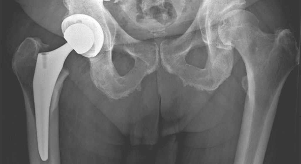 Total Hip Arthroplasty Total Hip Arthroplasty
