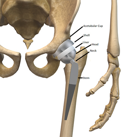 Total Hip Arthroplasty - CU Sports Med Hip Clinic